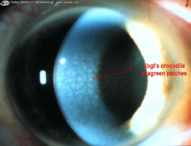 Medicine Decoded: Eponyms about Vogt - Ophthalmology